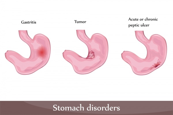 Gastritis - Health Facts