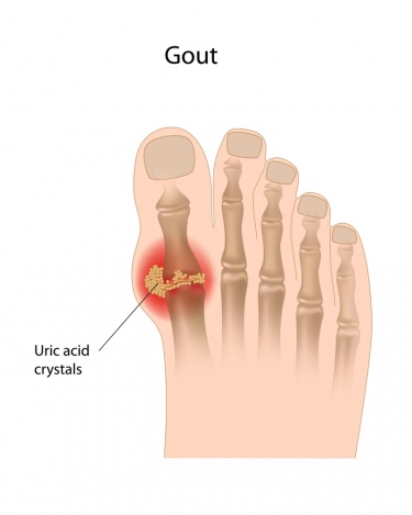 Gout - Health Facts