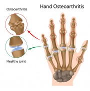 Osteoarthritis - Health Facts