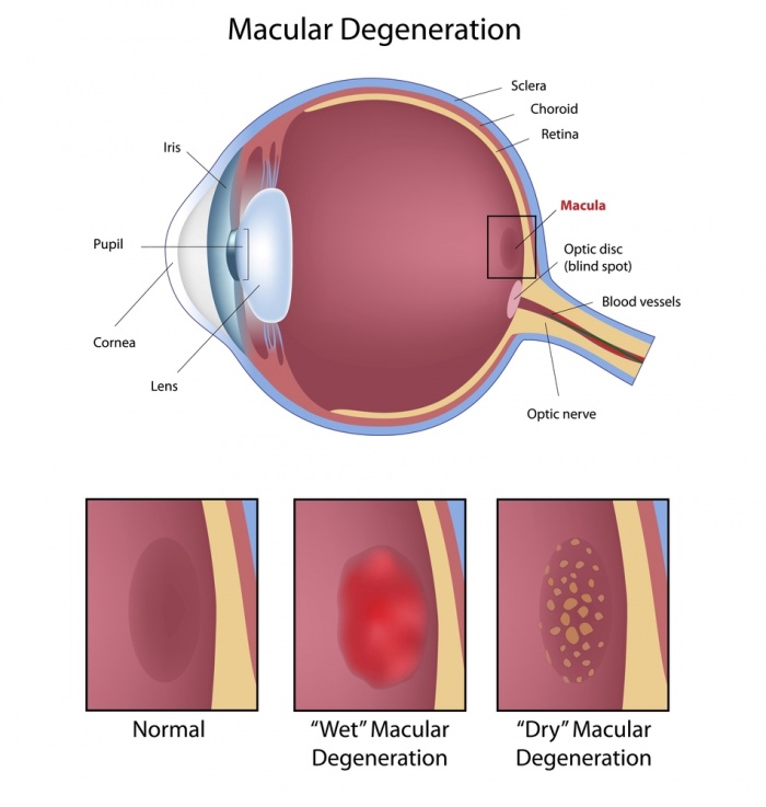 Macular Degeneration - Health Facts