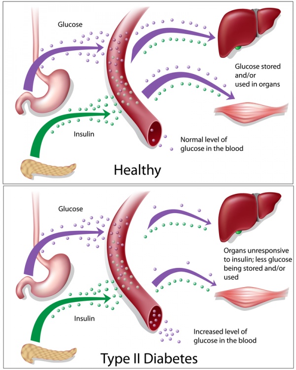 Type II Diabetes - Health Facts